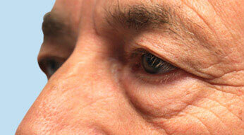 Onderooglidcorrectie | Velthuis kliniek