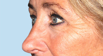 Neuscorrectie | Velthuis kliniek