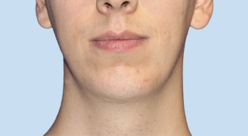 Kincorrectie | Velthuis kliniek