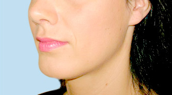 Kincorrectie | Velthuis kliniek