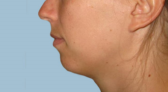 Kincorrectie | Velthuis kliniek