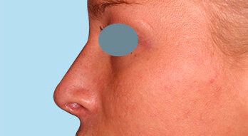 Neuscorrectie | Velthuis kliniek