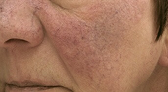 Couperose - Huidaandoening
