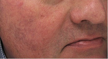 Couperose - Huidaandoening