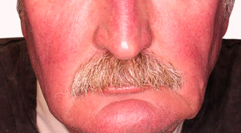 Couperose - Huidaandoening