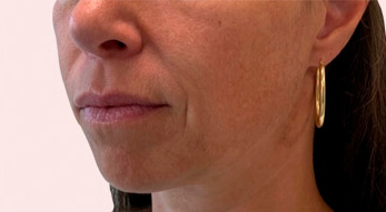 Neuslippenplooi met fillers | Velthuis kliniek
