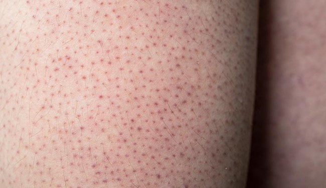 Keratosis Pilaris, wat is dat?